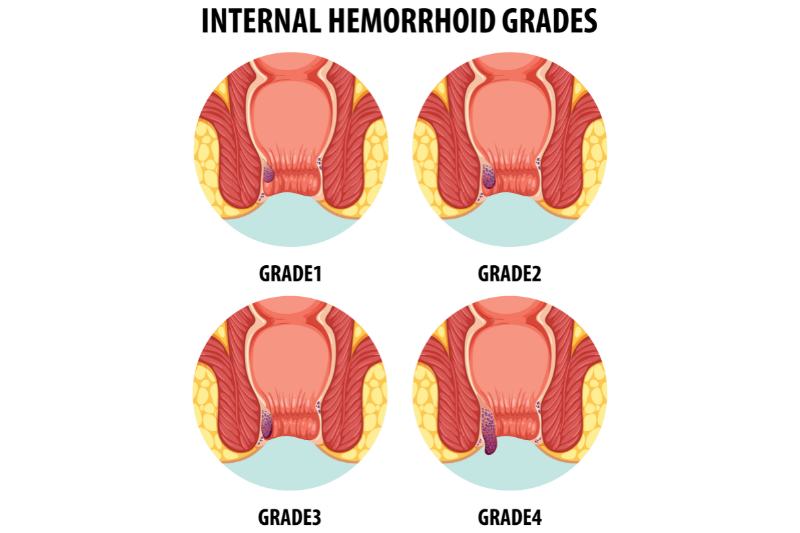Four Grades Of Hemorrhoids Guide With Treatment Options 6515