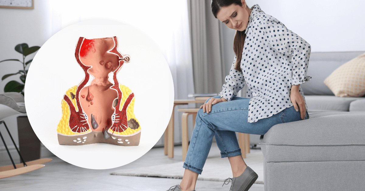 Lump On The Anus Causes Symptoms And Treatment Options 4745